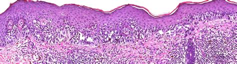 Pathology Outlines Invasive Melanoma