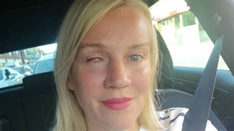 Woman Lost An Eye After Firework Exploded In Her Face Hundreds Of