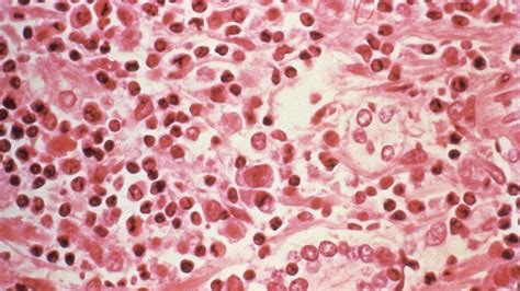 Muere Una Mujer Por Hantavirus En Argentina La Primera Víctima Fatal