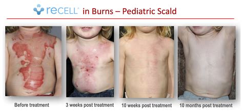 Fluid Replacement For Burn Victims At Alesia Lehr Blog