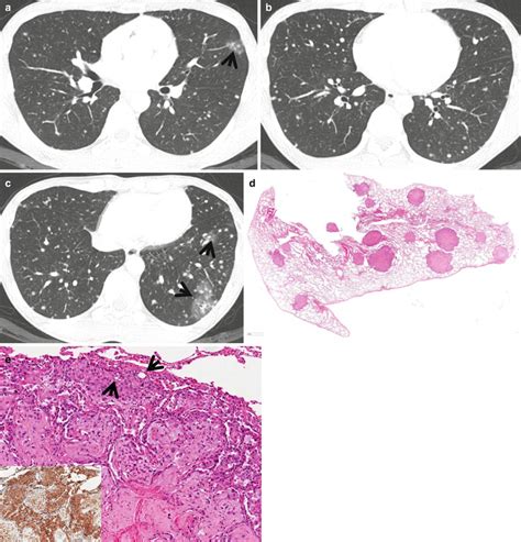 Multiple Nodular Or Mass Like Pattern Radiology Key