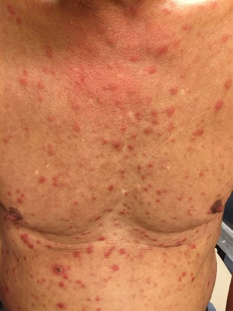 Dengue Archives — Geosentinel