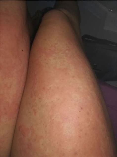 Hyperthyroidism Rash