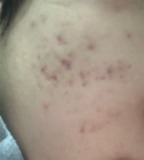 피부 여드름 흉터 문제 지식in