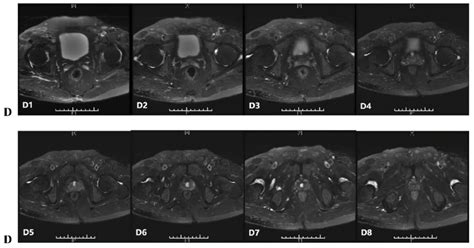 prostatic mri of a patient of group a a a1 a8 pre treatment dwi