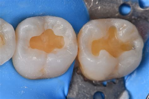 Rapid Sequence Layering Using A Supercomposite By Voco Rapid Sequence Layering Using A Supercomposite By Voco