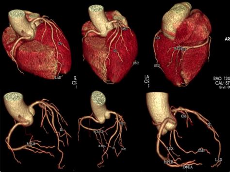 Cardiac Multislice Ctprospective Ecg Retrospective Ecg Gatingpptx