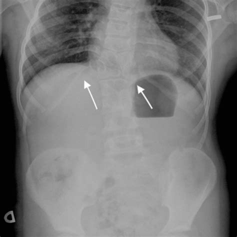 A 10 Days Post Operative Aspect A Showing The Depth Of The Neovagina