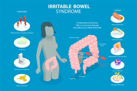 Irritable Bowel Syndrome Ibs Bella Vista