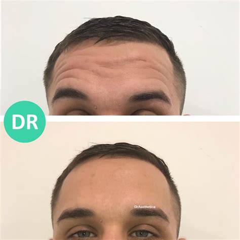 Static Vs Dynamic Wrinkles How To Get Rid Of Both Dr Aesthetica