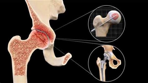 Hip Avascular Necrosis Avn Treatment Options Orthopedia Patient