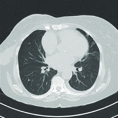 Ct Angiogram Of The Thorax Performed 2 Weeks After Radical Right