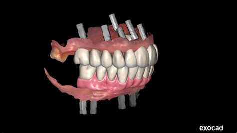 Full Mouth Occlusion Reconstruction Using Digital Technology