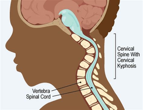 Cervical Kyphosis Causes Symptoms Diagnosis And Treatment