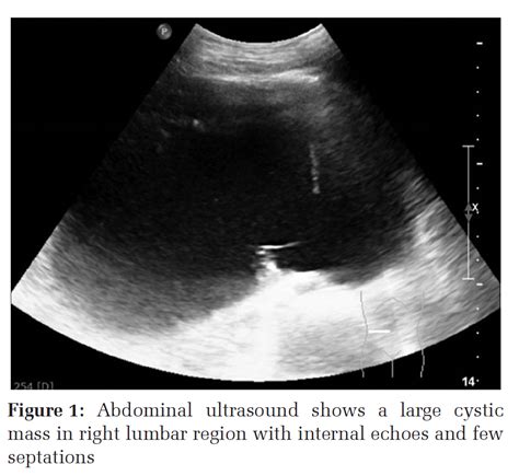 Retroperitoneal Cyst An Unusual Presentation Of Filariasis