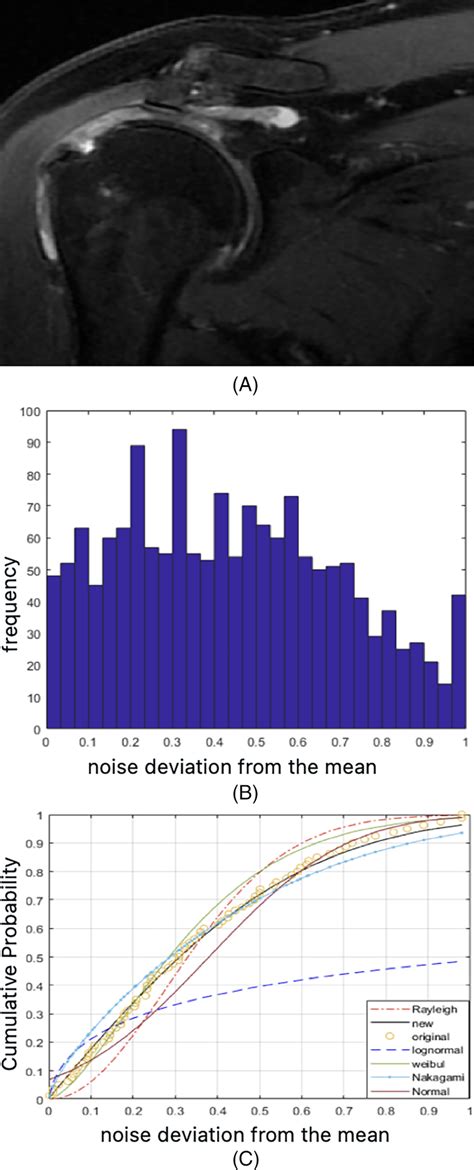 a pathological shoulder mri image b histogram c distribution