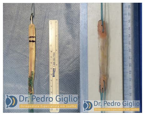 Ligamento Cruzado Anterior Dr Pedro Giglio Especialista Em Joelho