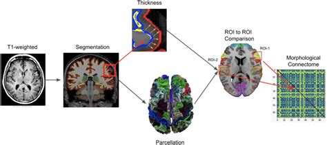 Classification Of Multiple Sclerosis Clinical Profiles Using Machine Learning And Grey Matter