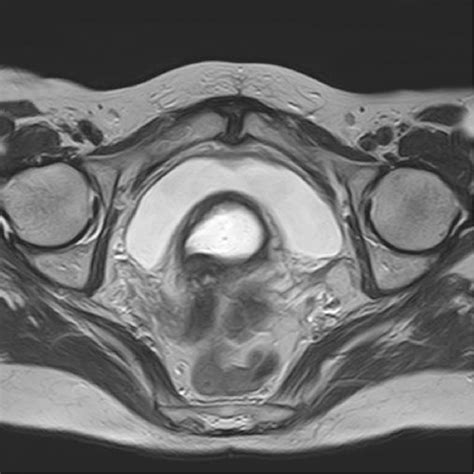 Figure 2 From Mr Imaging In Patients With Pelvic Organ Prolapse