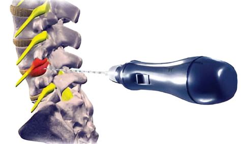 Percutaneous Discectomy Minimally Invasive Spine Surgery