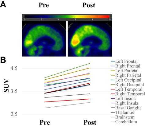 Apomorphine For Prolonged Disorders Of Consciousness A Multimodal Open