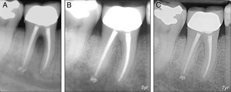 Apically Extruded Sealers Fate And Influence On Treatment Outcome Journal Of Endodontics