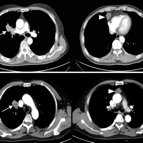 The Thymic Cyst Opened Showing The Nodules Of Tumour Tissue In Its