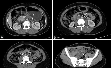 A D Axial Contrast Enhanced Computed Tomography Sleeve Of Download Scientific Diagram