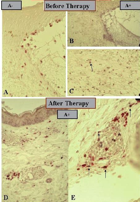 Before Methotrexate Mtx Treatment In Patient 3 The Negative Control Download Scientific