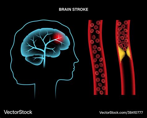Brain Stroke Ishemic Royalty Free Vector Image