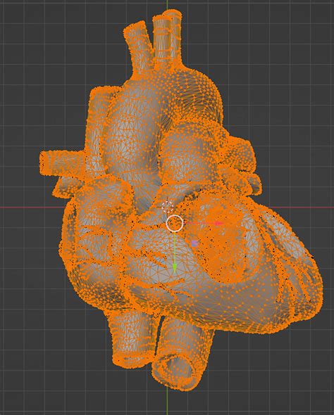 3d Model Of Partial Anomalous Pulmonary Venous Connection By Azekapeka