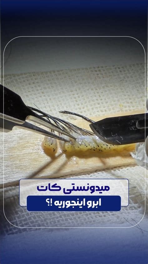 ‎الهام علومی کاشت ابرو کاشت مو تهران‎ ‎اصلاح ابرو ️ Elham