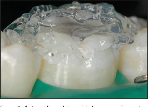 Figure 3 From Utilization Of Occlusal Index And Layering Technique In Class I Silorane Based