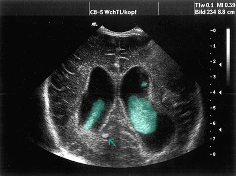 Torch Infection Head Ultrasound At Loretta Burroughs Blog