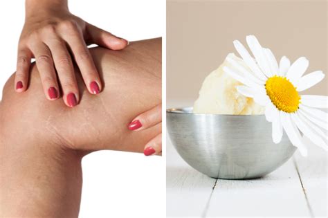 Shea Butter For Stretch Marks Full Guide Eat Quick Healthy
