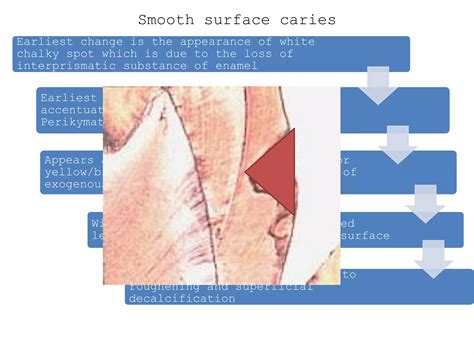 Pathogenesis Of Dental Caries Ppt