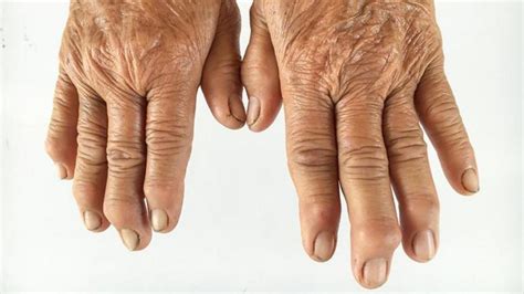 ¿qué Son Los Nódulos De Heberden Y Bouchard Gcm Glucoplus