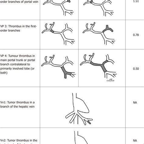 Portal Vein Tumor Thrombosis Classification According To The Liver Download Scientific Diagram