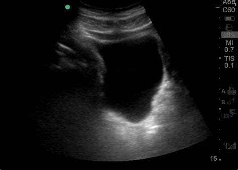 File Normal Sagittal Bladder  Wikem