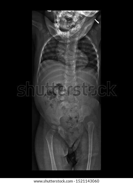 Hemivertebra Photos And Images Shutterstock