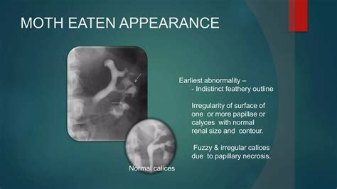 Intravenous Urogram Ivu Ppt