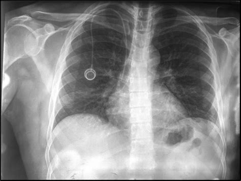Chest X Ray Of An Hiv Patient Showing Multi Bilateral Nodules And