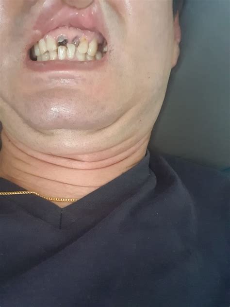썩은이빨 치료비용 치과 지식in