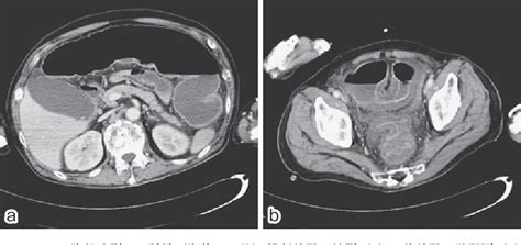 Figure 2 From [a Case Of Pseudomembranous Colitis Concomitant With Toxic Megacolon And Paralytic