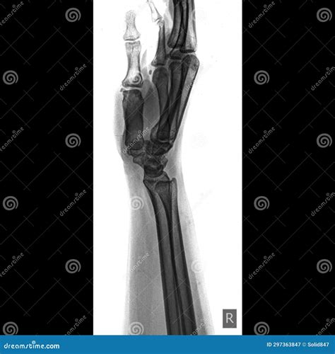 Wrist Joint X Ray Image Lateral View On Isolated White Background Stock
