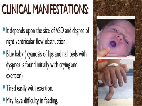 Tetralogy Of Fallot And Tet Spell Presentation