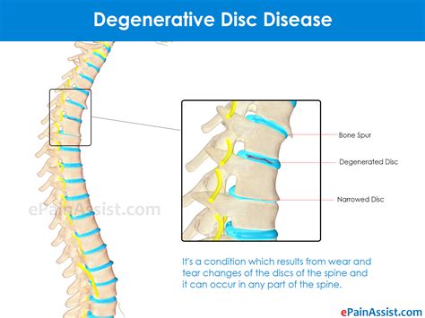 Thoracic Degenerative Disc Disease Degenerative Disease Disc Arthritis