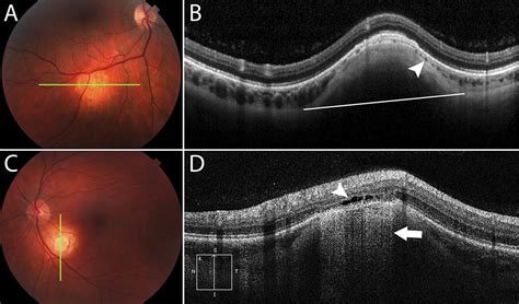 Choroidal Osteoma Oct