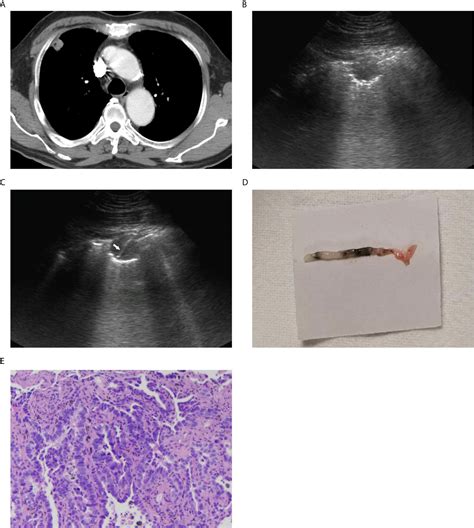 Ultrasound Guided Biopsy Riglers Sign Radiology At St Vincents