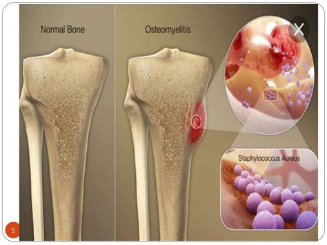 Osteomyelitis Orfanused Lecture Notes Pt Ppt